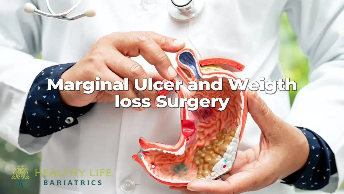 Marginal ulcer and weight loss surgery in LA, CA | HLB